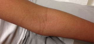 Sore Throat and Red Rash on the Body